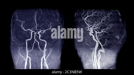 Basilar artery aneurysm, MRI scan Stock Photo - Alamy