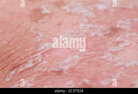 textured background with scales of dead skin cells with redness and ...