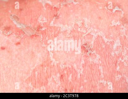 skin texture with scales of dead cells and redness after sunburn come ...