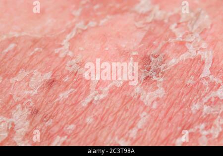 texture of irritated reddened skin with flaking scales and cracks from ...