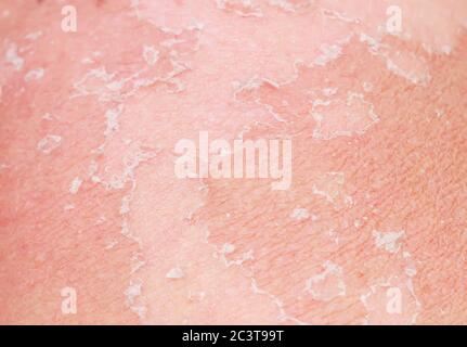 texture of irritated reddened skin with flaking scales and cracks from ...