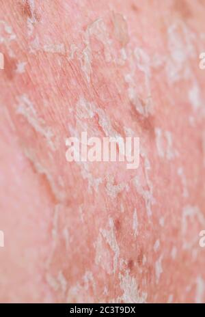texture of irritated unhealthy skin with scales of dead cells and ...