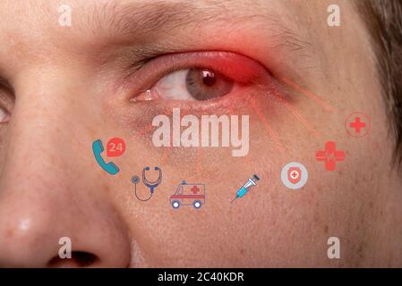 Close the upper left eyelid abscess. Eye with barley. Barley diseases ...