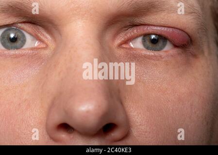 Close the upper left eyelid abscess. Eye with barley. Barley diseases ...