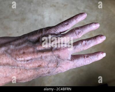 Age spots on the forearm of a 72-year-old woman Stock Photo - Alamy