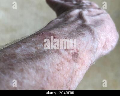 Age spots on the forearm of a 72-year-old woman Stock Photo - Alamy