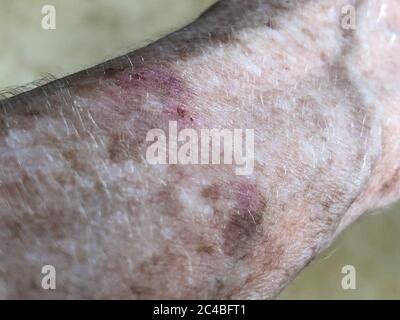 Age spots on the forearm of a 72-year-old woman Stock Photo - Alamy