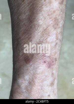Age spots on the forearm of a 72-year-old woman Stock Photo - Alamy