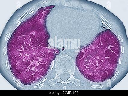 Pulmonary fibrosis (lesion of the lungs characterized by the presence ...