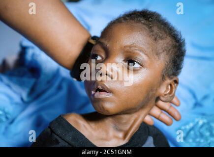 Malnourished boy James-Domenik (5) in the hospital in Tamale / Ghana ...