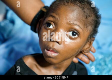 Malnourished boy James-Domenik (5) in the hospital in Tamale / Ghana ...
