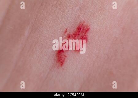 painful surface skin injury bleeding scratches on human male body ...