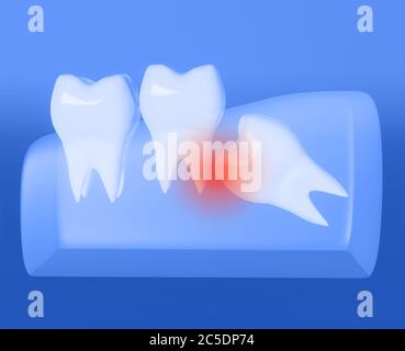 Wisdom tooth grows wrong, wisdom tooth problem, horizontal position of ...