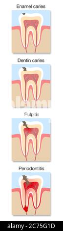 Tooth anatomy, medical labeled cross section chart with enamel, dentin ...