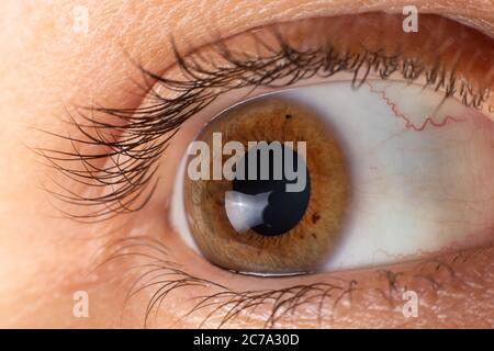 Keratoconus of eye, 4th degree. Contortion of the cornea in the form of ...