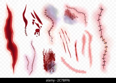Realistic scars. Wound, surgical stitches and bruis, skin cuts. Bloody wounds vector isolated ...