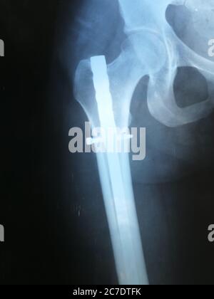 This stock photo shows the X-ray of a femur after surgery with the ...
