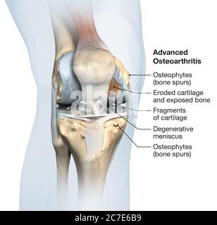 Illustration showing painful advanced osteoarthritic knee joint Stock ...