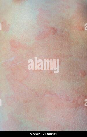 Urticaria reaction. Itchy, red rash (weals) on the leg of a 45-year-old ...