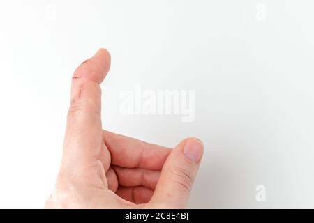 a cut index finger with a extensor tendon injury, mallet finger, tip of ...
