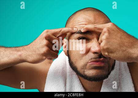 Young man with acne and pimple on the skin with brown spots, Acne on ...