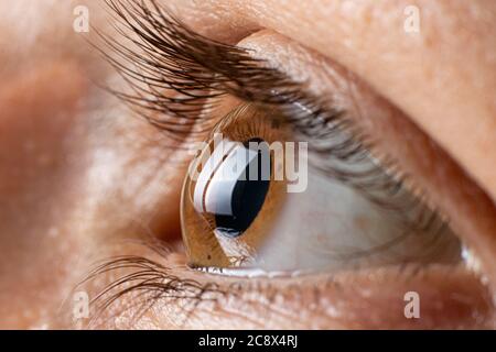 Corneal dystrophy. Close-up of an eye with corneal dystrophy stained ...