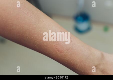 Toddler's bite marks on mothers arm - aggressive toddlers behavior ...