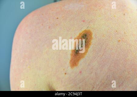 Benign mole. Melanocytic (pigmented) naevus, also known as a mole, on ...