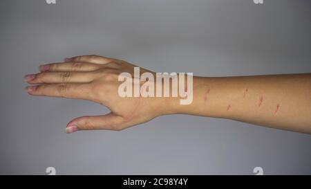 Cat Scratch Disease. A scratched female hand from a cat Stock Photo - Alamy