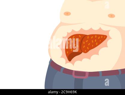 Stages human liver damage concept. Healthy liver steatosis fatty NASH ...