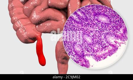 Acute appendicitis, computer illustration and light micrograph ...