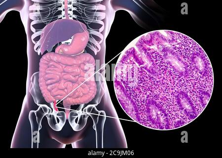 Acute suppurative appendicitis, computer illustration and light ...