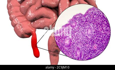 Acute suppurative appendicitis, computer illustration and light ...