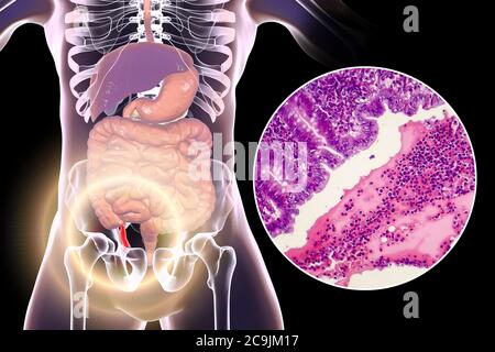 Acute appendicitis, computer illustration and light micrograph ...