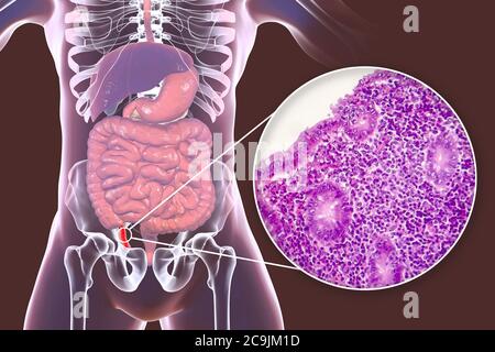 Acute appendicitis, computer illustration and light micrograph ...