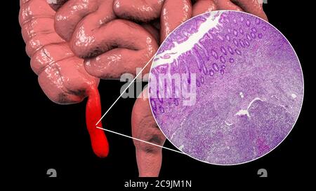 Acute appendicitis, computer illustration and light micrograph ...
