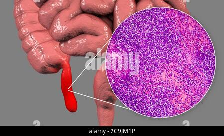 Acute appendicitis, computer illustration and light micrograph ...