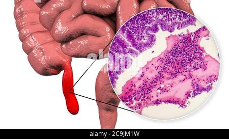 Acute suppurative appendicitis, computer illustration and light ...