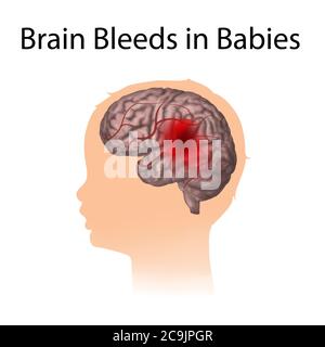 Human brain haemorrhage, illustration Stock Photo - Alamy