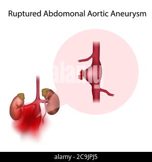Ruptured aneurysm, illustration. An aneurysm is a blood-filled dilation ...