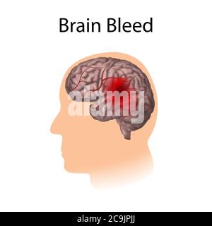 Human brain haemorrhage, illustration Stock Photo - Alamy