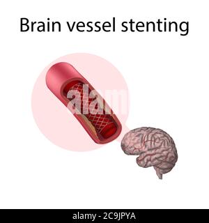 Brain blood vessel angioplasty and stenting, illustration. Stages of ...