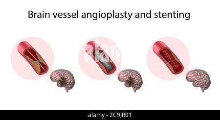 Atherosclerosis stages, illustration Stock Photo - Alamy