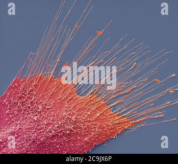 Bone cancer cell. Coloured scanning electron micrograph of an ...