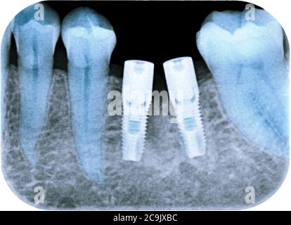 Dental implants following tooth extraction, X-ray. During this surgery ...