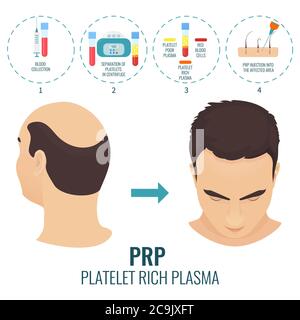Platelet-rich plasma (PRP) procedure, illustration Stock Photo - Alamy