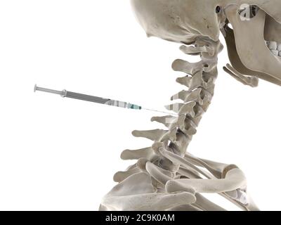 Spinal injection, illustration Stock Photo - Alamy
