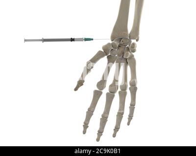 Wrist injection, illustration Stock Photo - Alamy
