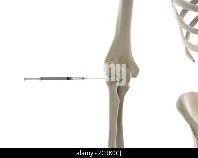 Elbow injection, illustration Stock Photo - Alamy