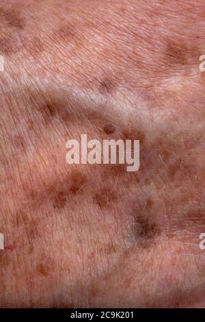 Liver spots on female skin Stock Photo - Alamy